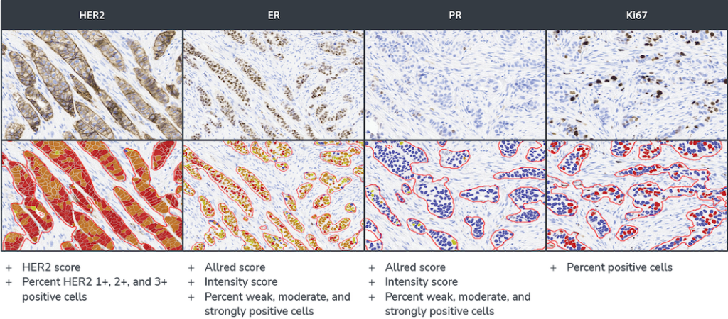 Breast IHC AI - Indica Labs