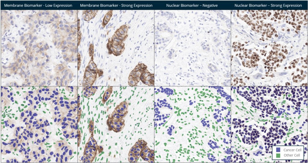 Breast IHC Cancer Cell Phenotyper - Indica Labs