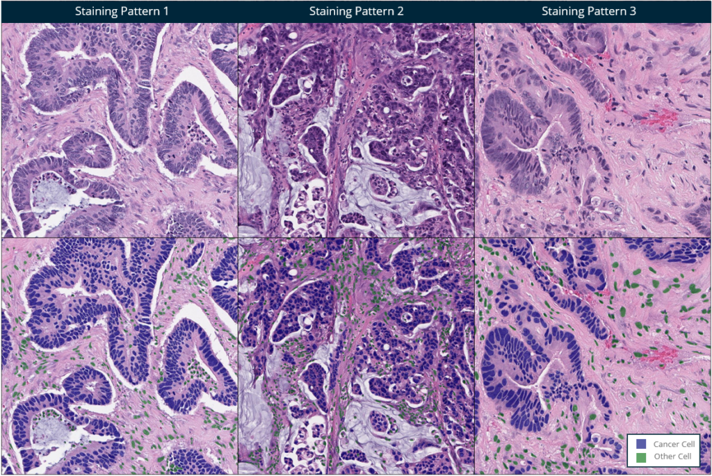CRC H&E Cancer Cell Phenotyper - Indica Labs