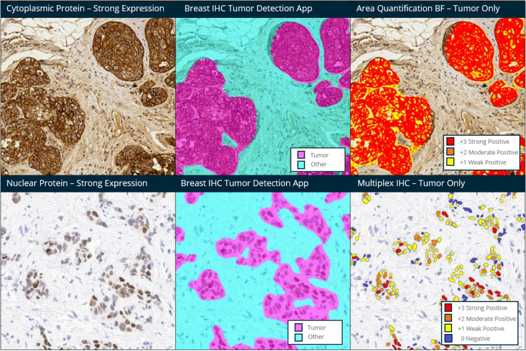 Breast IHC Tumor Tissue Detection - Indica Labs