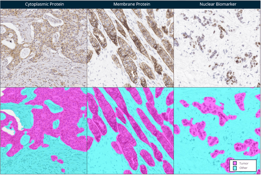 Breast IHC Tumor Tissue Detection - Indica Labs