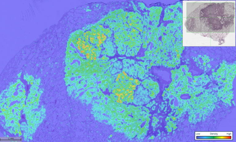 NSCLC H&E Cancer Cell Phenotyper - Indica Labs