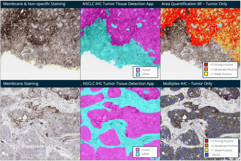 NSCLC IHC Tumor Tissue Detection - Indica Labs