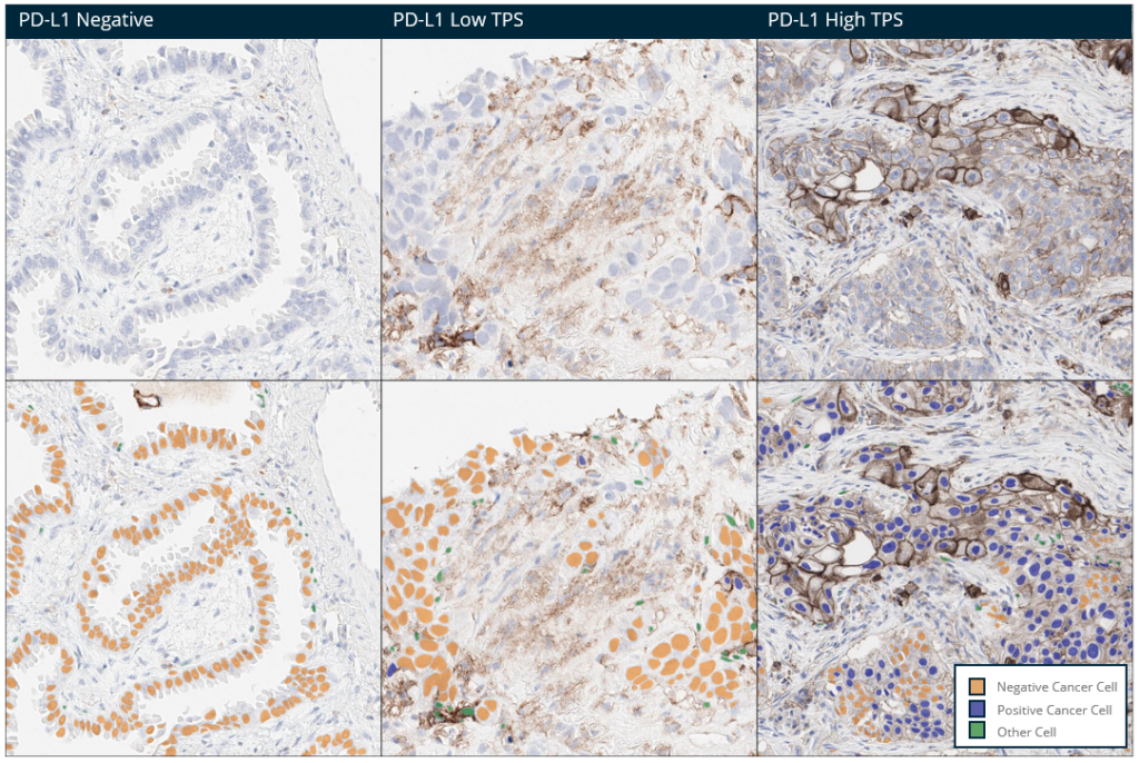 NSCLC IHC Cancer Cell Phenotyper - Indica Labs