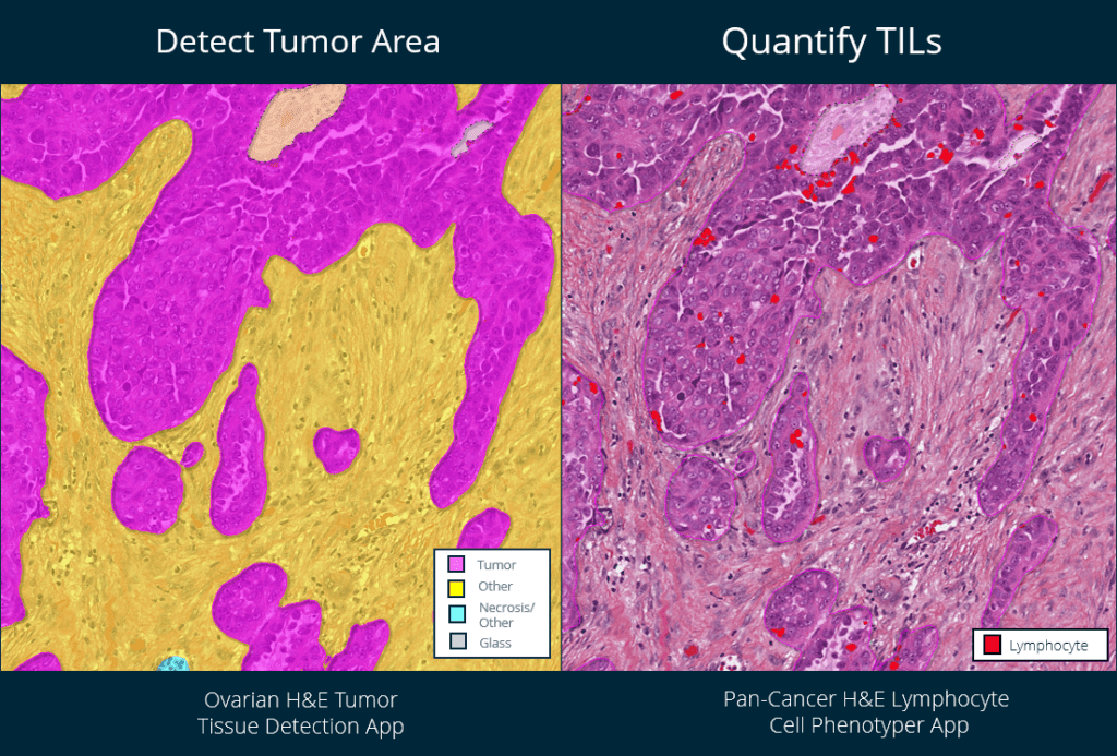 Ovarian H&E Tumor Tissue Detection - Indica Labs