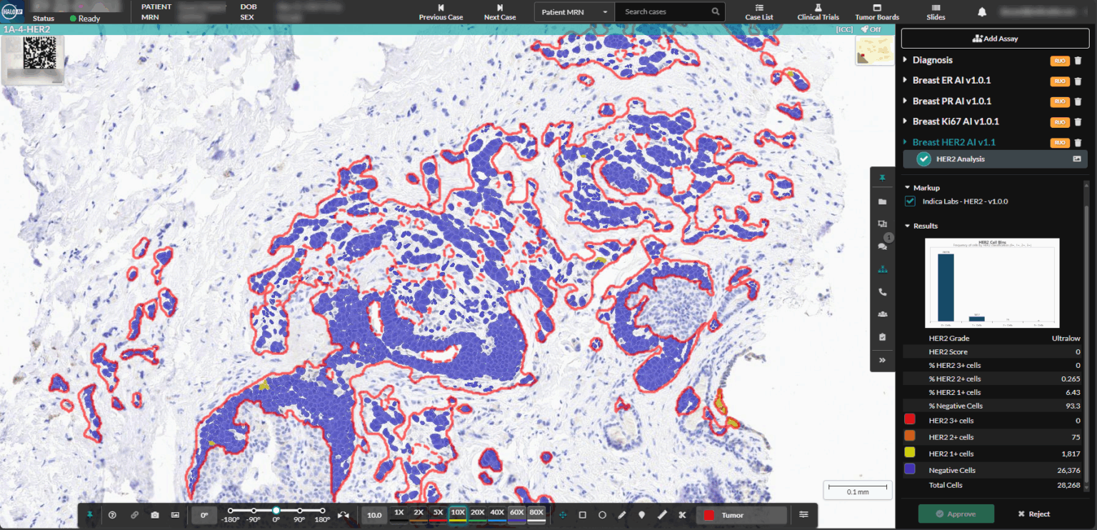 Low and Ultralow HER2 Expression in Breast Cancer is Now Detectable by ...