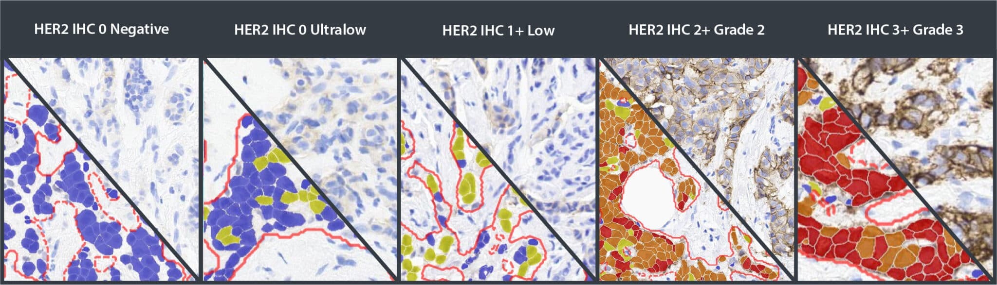 Breast IHC AI - Indica Labs